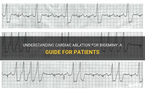 Understanding Cardiac Ablation For Bigeminy A Guide For Patients Medshun