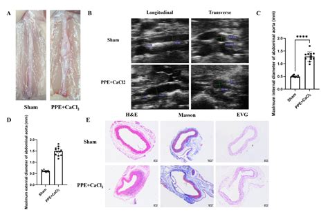 A Mouse Abdominal Aortic Aneurysm Model By Periadventitial Calcium Chloride And Elastase