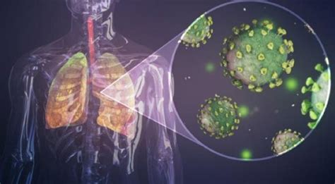 Identifican Daño Pulmonar Que Estaría Asociado A Un Síndrome Conocido