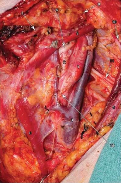 Salvage Neck Dissection Indications Workup And Technical