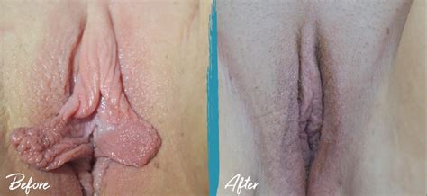 Vaginal Rejuvenation Before And After Pictures Labiaplasty Nyc