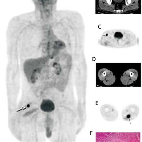 Retrocrural Lymph Node Rcln Metastasis Rates According To Download Table