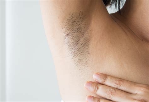 Заболевания волос на подмышках 82 фото