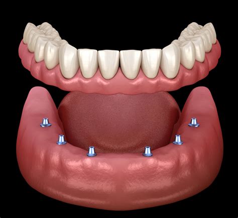 Implant Supported Dentures Procare Denture Implant Cl