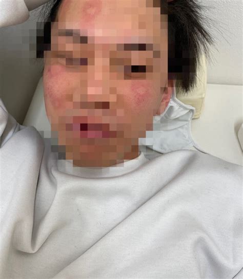 蕁麻疹（じんましん）の原因や症状、対処法について解説｜冷やすのが良い時もある？