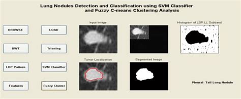 Figure 1 From Analysis Of Lung Nodule And Classification Based On Svm Classifier And Fuzzy C
