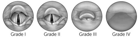 Tracheal Intubation Online Supplement