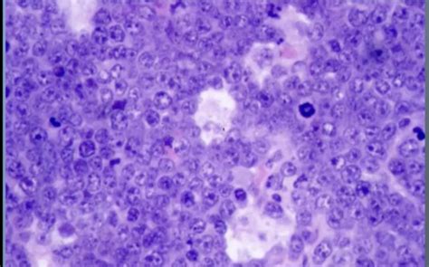 Gen Path Exam 2 Neoplasia Flashcards Quizlet