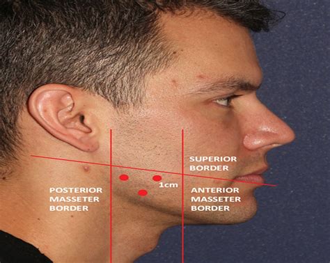 The Masseter Muscle And Its Role In Facial Contouring Aging