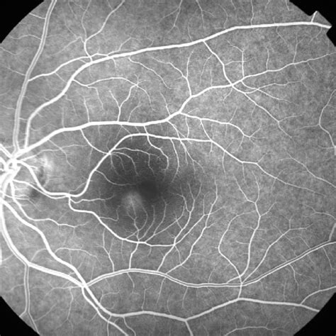 Dynamic Contrast Enhanced Breast Mri Following 4 Cycles Fec