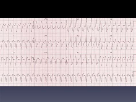 Systematic Ecg Interpretation Ppt