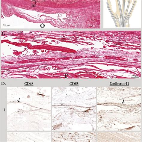 Example Mr Image Of Extensor Tenosynovitis At Mcp 4 Arrow And Flexor