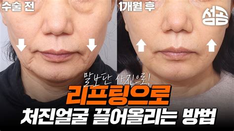 안면거상하안검은 젊어지는 지름길 사진으로 확인하자 안면거상 이마거상 하안검 Youtube