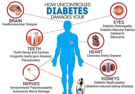 Gluxus Health Comfortaid Diabetes And Foot Care Diabetic Neuropathy