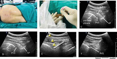 Figure 1 From Successful Percutaneous Nephrolithotomy Using Thoracic Paravertebral Block As The