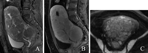 Case Report Magnetic Resonance Imaging Findings Of Patients With Diffuse Uterine Leiomyomatosis