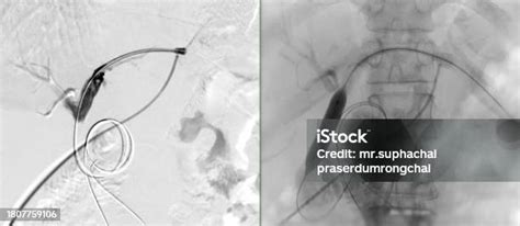 Percutaneous Transhepatic Biliary Drainage Is A Medical Procedure Used
