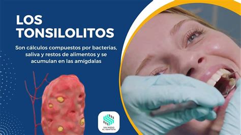¿quÉ Son Los Tonsilolitos Youtube