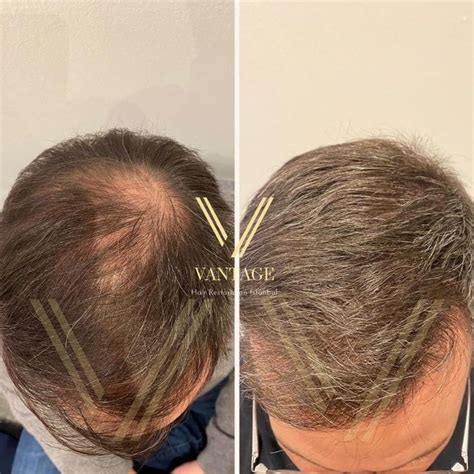 Pin On Hair Transplant In Istanbul
