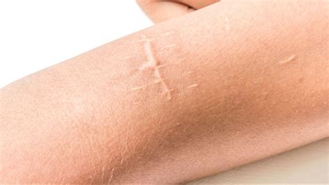 Aprende A Cuidar Correctamente De Las Cicatrices Para No Dañar La