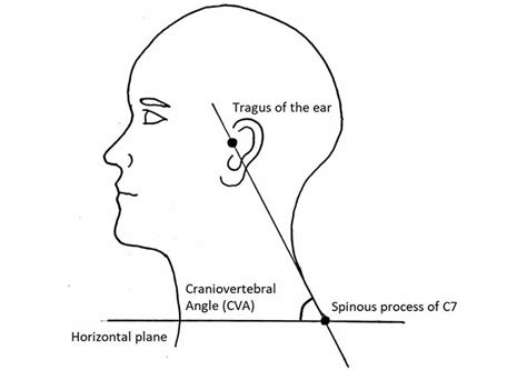 Relationships Between Cervical Sagittal Posture Muscle 57 Off