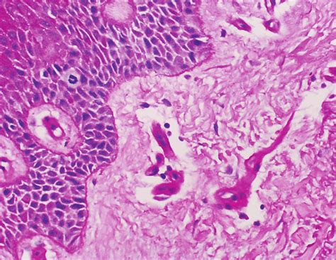 Porphyria Cutanea Tarda Periodic Acid Schiff Staining Depicting