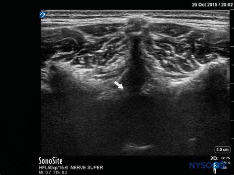 Pediatric Epidural And Spinal Anesthesia And Analgesia Nysora