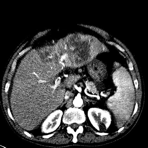 Cholangiocarcinoma Radiopaedia