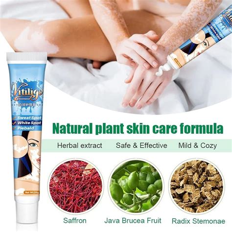 Crema De Terapia De Vitíligo Tratamiento De Vitíligo Crema Para El