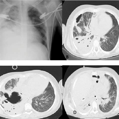 A Postero Anterior Chest X Ray Day 1 Diffuse Pulmonary Opacity With