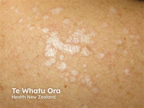 Idiopathic Guttate Hypomelanosis Dermoscopy