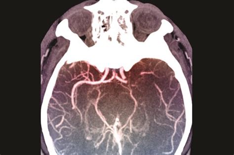Middle Cerebral Artery Clot On Computed Tomography Ct Scan Source