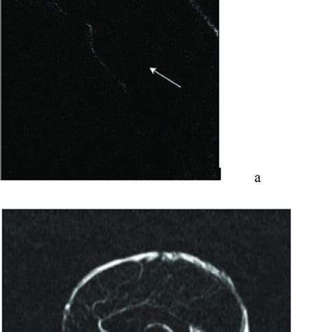 Different Causes Of Tonsillar Descent I Small Posterior Fossa
