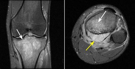 Bone Tumor Mri