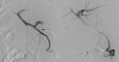 Figure 2 From Peristomal Variceal Bleeding Treated By Coil Embolization