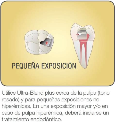 Cobertura Pulpar Bioactiva Con Ultra Blend Plus