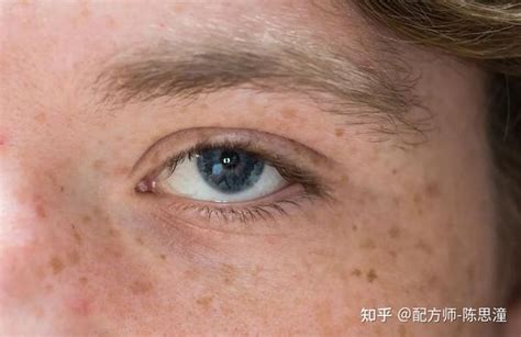 一分钟了解色斑的形成原因 知乎
