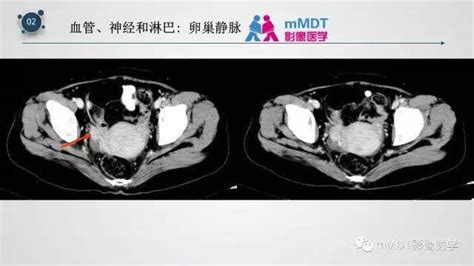 子宫附件影像解剖黄体