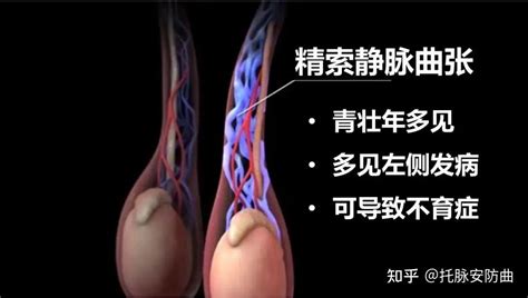 为什么年轻人过度手淫会导致精索静脉曲张？