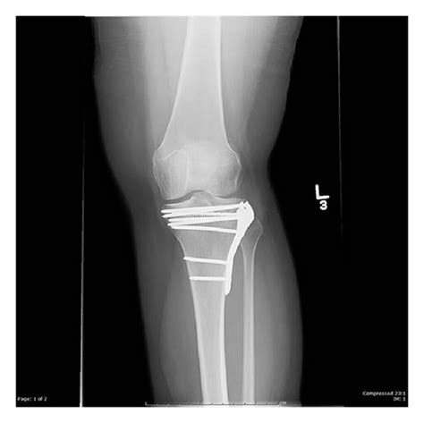 Ap And Lateral Plain Radiographs At Sixteen Months Postoperatively