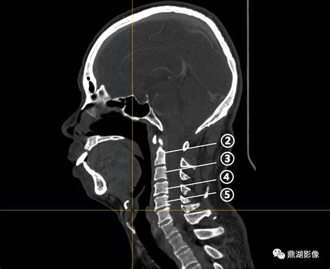 学了这么多年的颈动脉分叉定位竟然是错的？！解剖颈椎全网