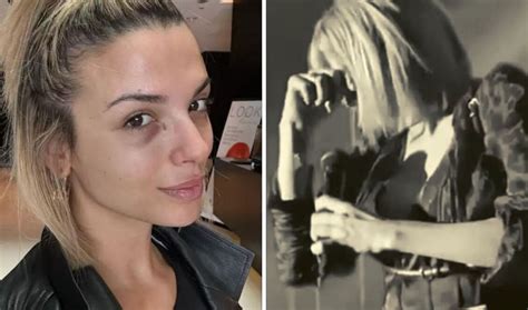 Κατερίνα Λιόλιου Η φωτογραφία με μελανιασμένο μάτι μετά το περιστατικό