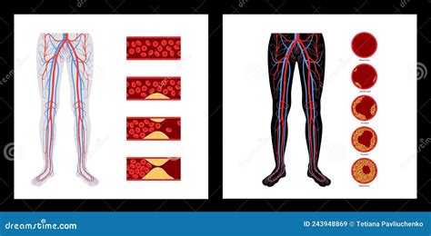 Peripheral Artery Disease Pad Vector Illustration Labeled Medical