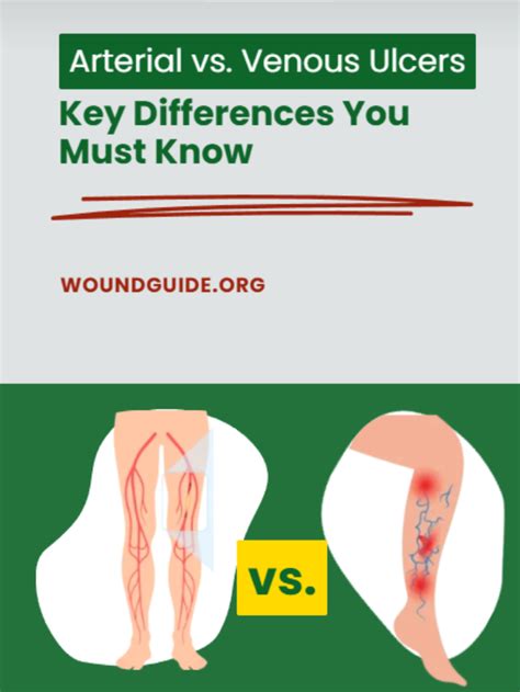 Arterial Ulcer Vs Venous Ulcer Key Differences Symptoms And Treatment