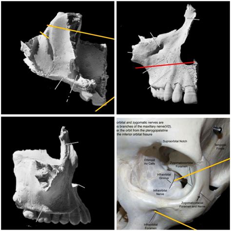 Maxilla Bone Anatomy Diagram Quizlet