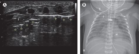Diagnosing Pneumomediastinum In A Neonate Using A Lung Ultrasound The