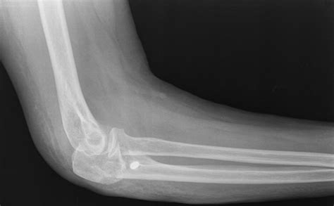 Technique Spotlight Parallel Plating Of Olecranon Fractures Clinical