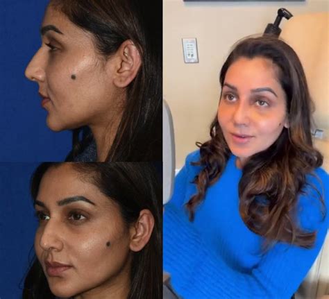 Deviated Septum Surgery Surgery Seattle Wa