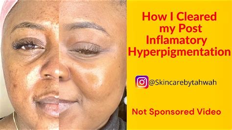 How To Clear Post Inflammatory Hyperpigmentation Poc Melanin Acne