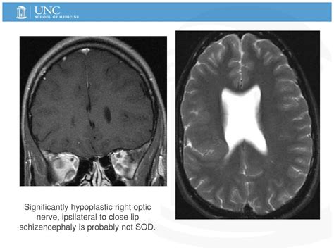 Ppt Septo Optic Dysplasia Tim Alves Powerpoint Presentation Free